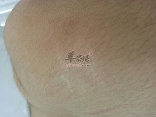 生长纹和肥胖纹的区别在哪里苹果绿